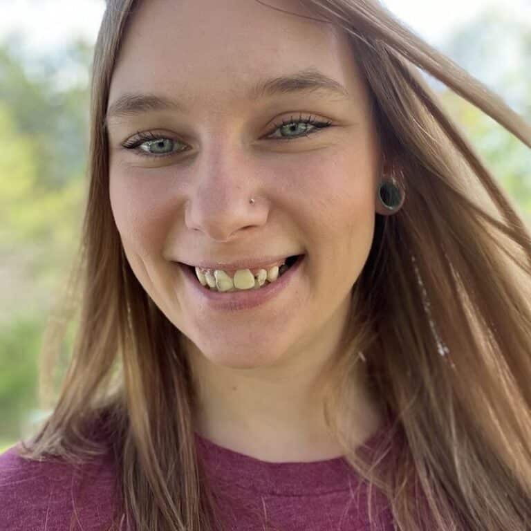 Shiny Smile Veneers | Natural-Looking Snap-On Veneers